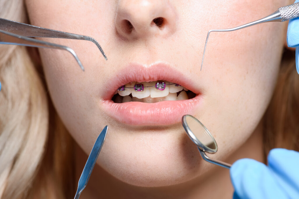 Broken Tooth Repair: Restore Your Smile with Confidence